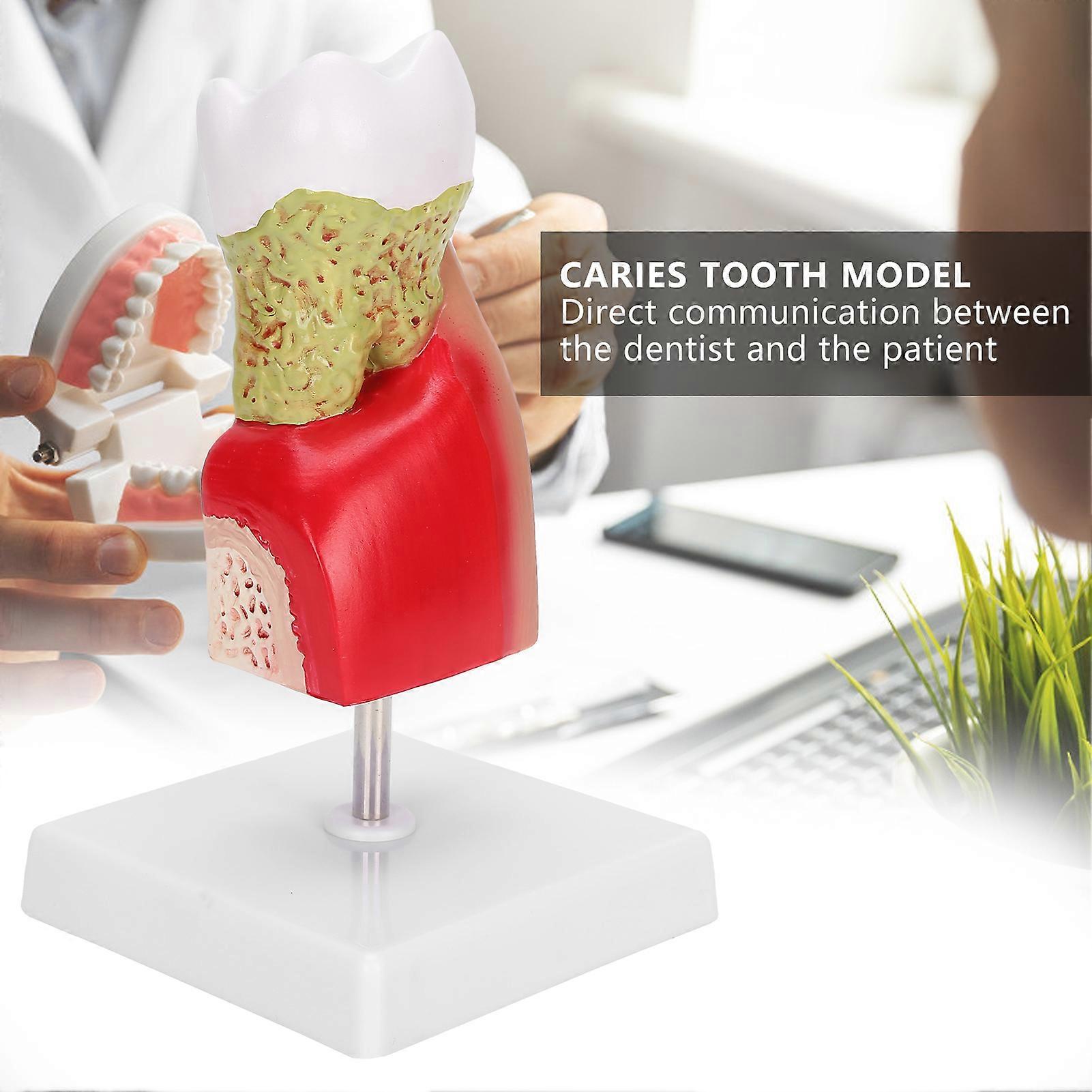 Dental Caries Tooth Model Dental Teeth Model for Teaching Training ...