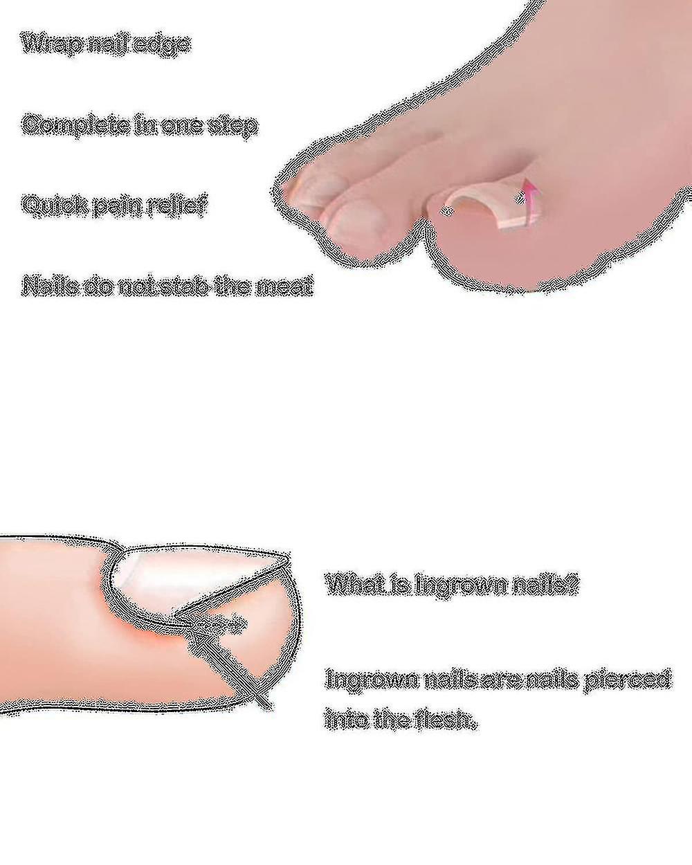 (50+2) Pack Professional Ingrown Toenail Correction Treatment Kit, 50 ...