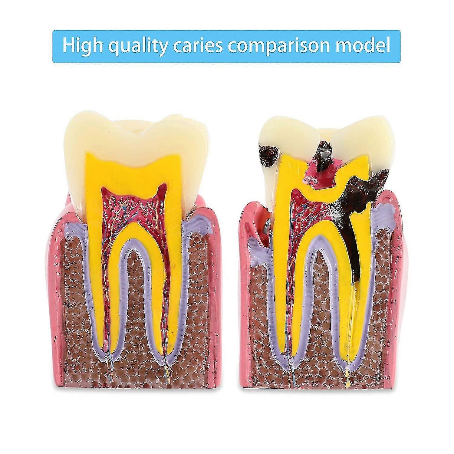 Dental Caries Tooth Model 6 Times Decay Teeth Comparative Study Model ...