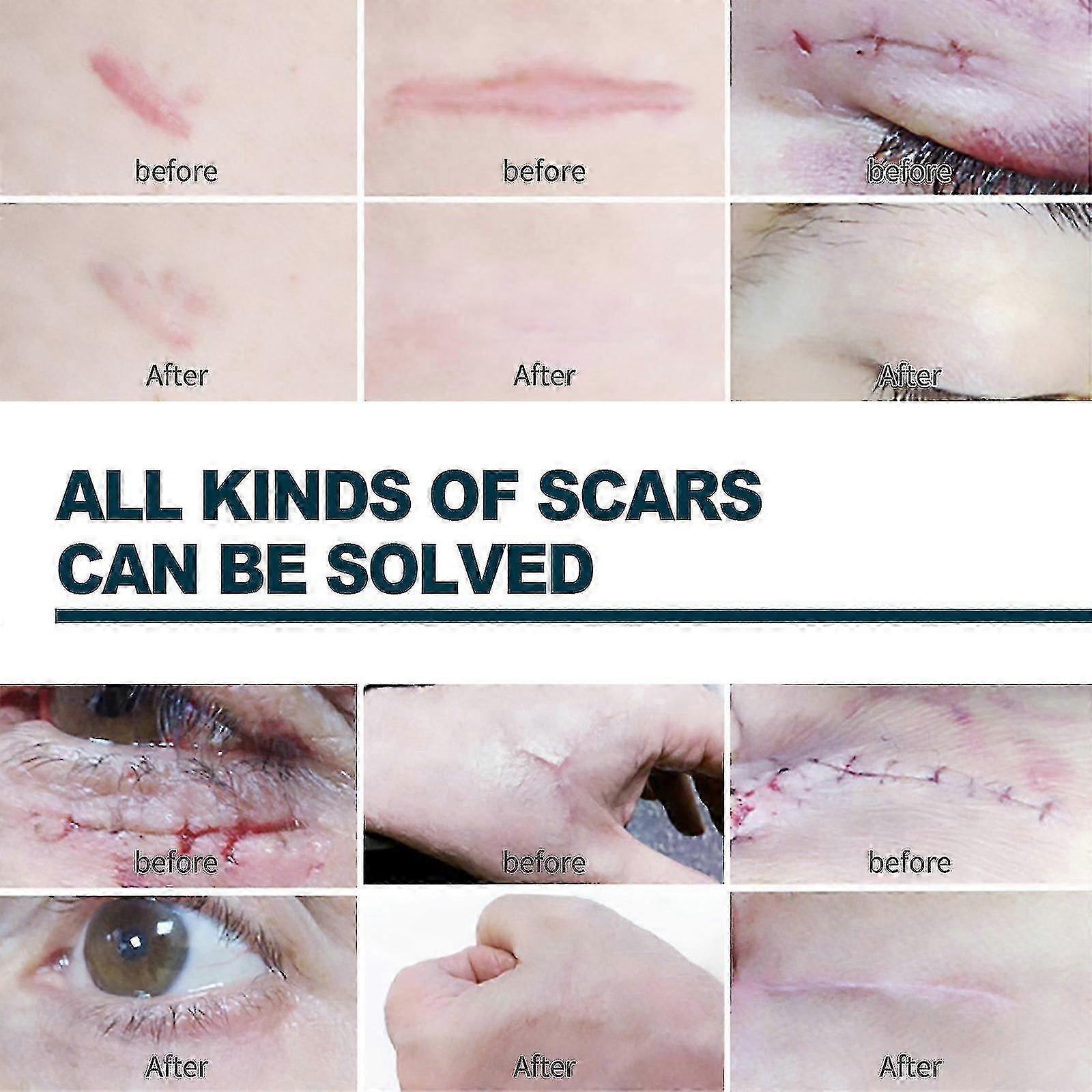 Silicone Scar Sheets - Extra Long Scar Sheets for C-Section, Tummy Tuck ...