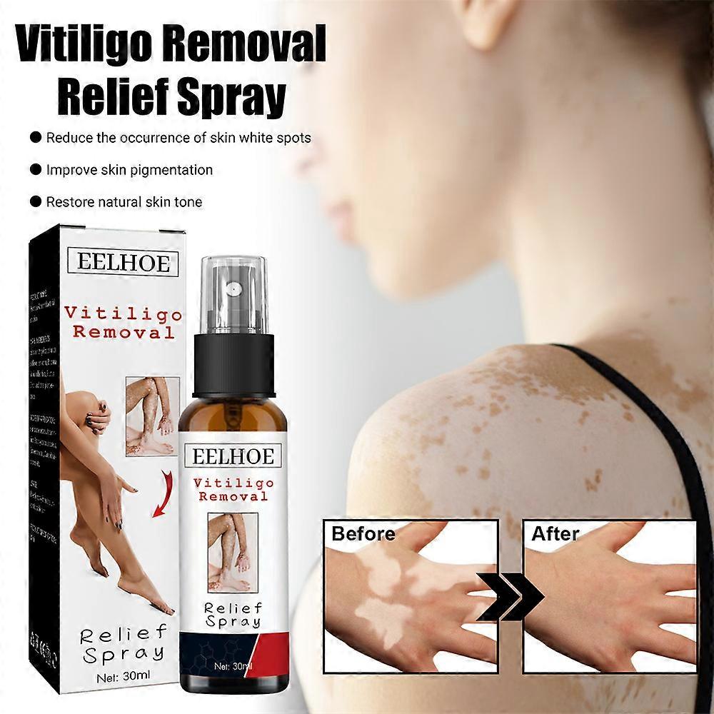 Vitiligo Removal Spray Skin White Spot Treatment Spray Moisturizing ...
