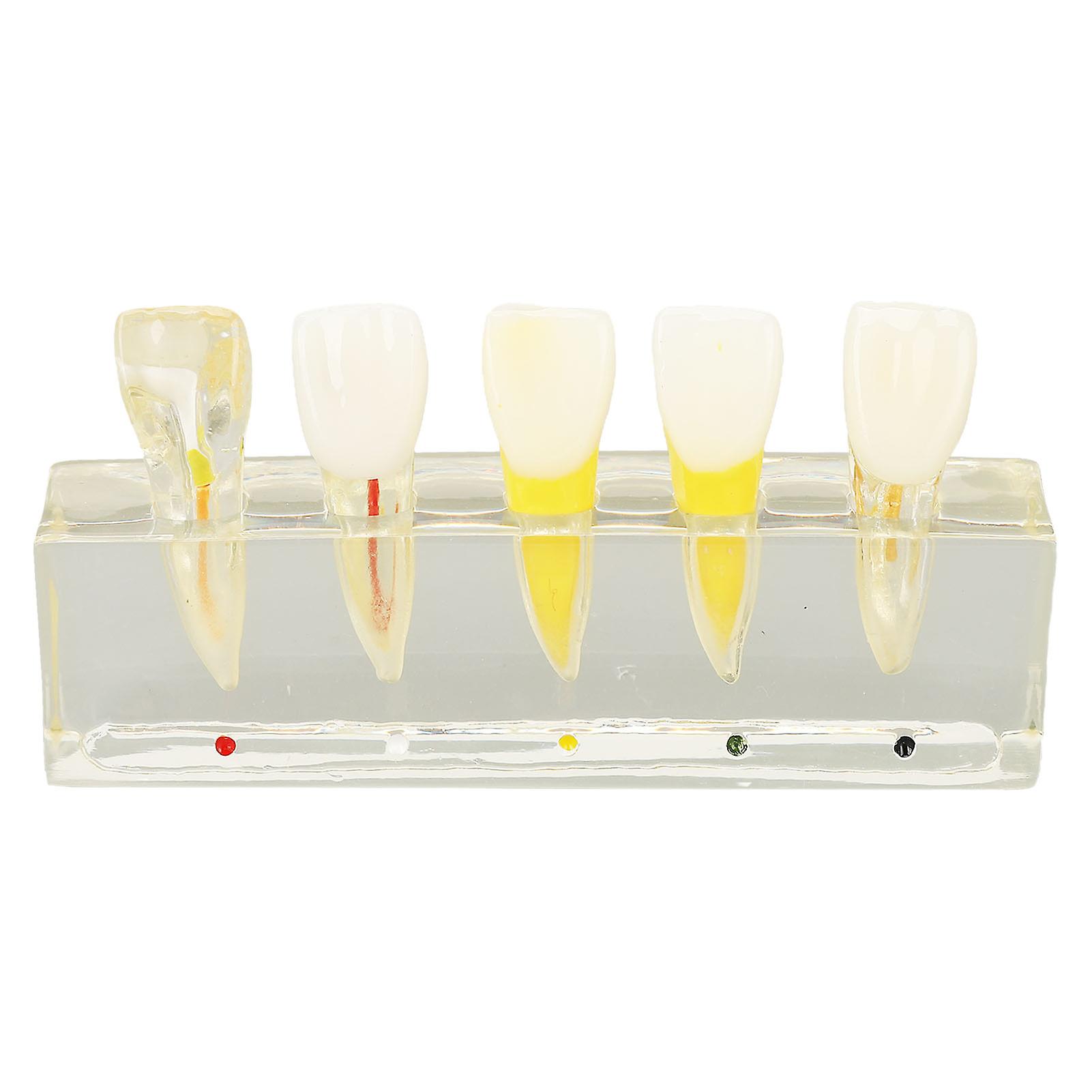 Dental Pulp Cavity Model Dental Hospital Resin Endodontic Teeth Model ...