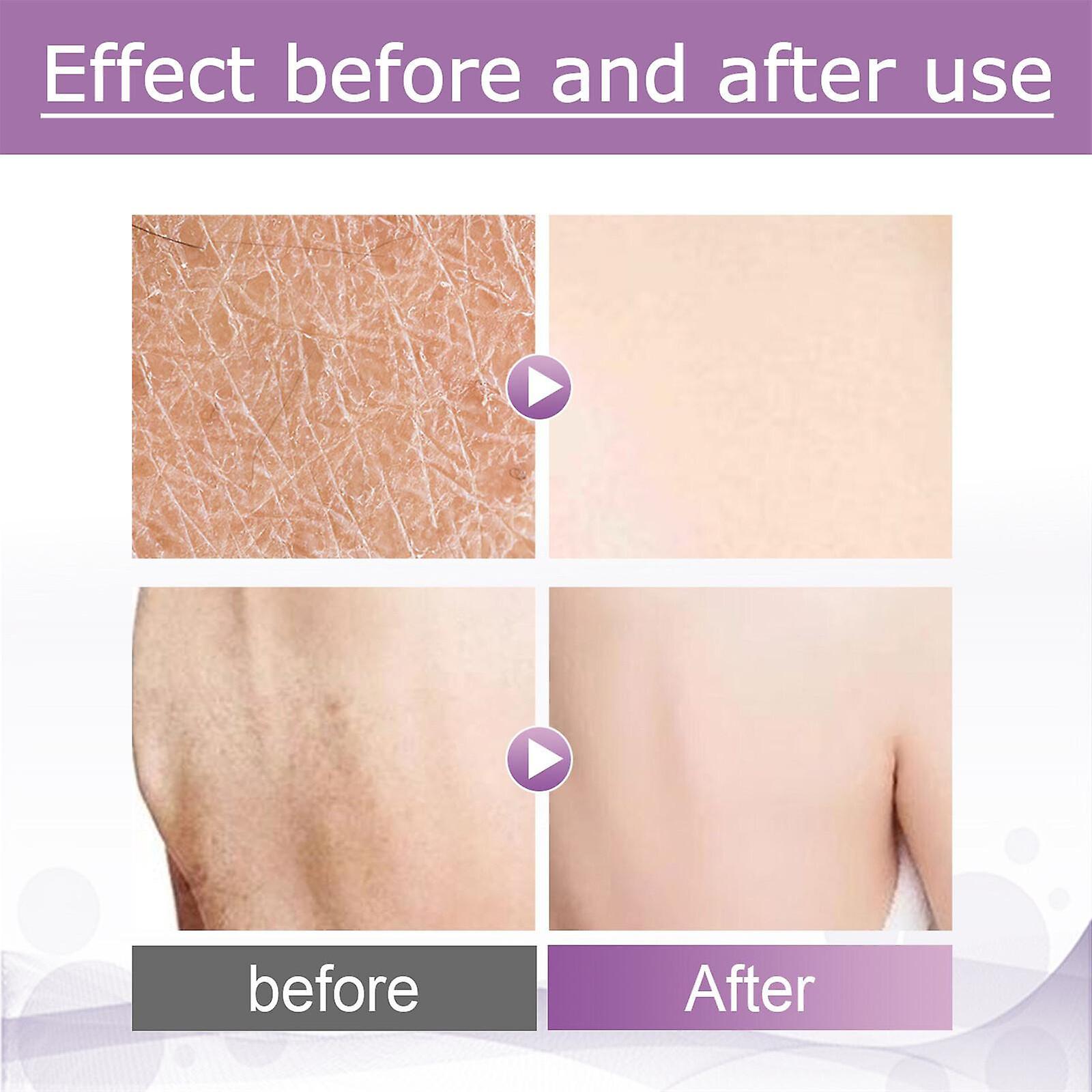 First Aid Beauty Bump Eraser Body Scrub Exfoliant for Keratosis Pilaris ...