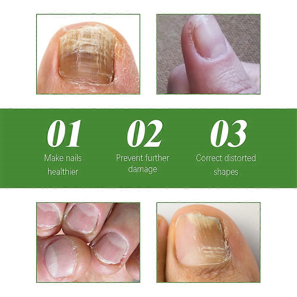 1-3pcs Nail Care Roller Balls - Nourishing Massage For Stronger, Faster ...