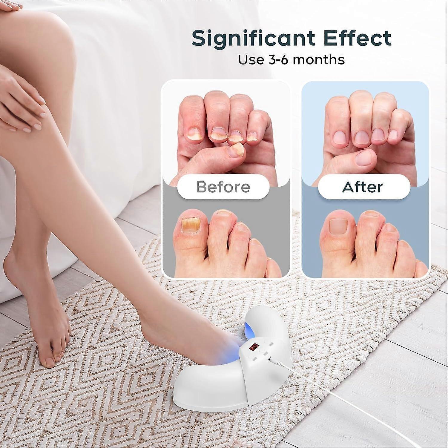 Nail Fungus Laser Treatment Device for Multiple Toenail, Home Use 905nm ...