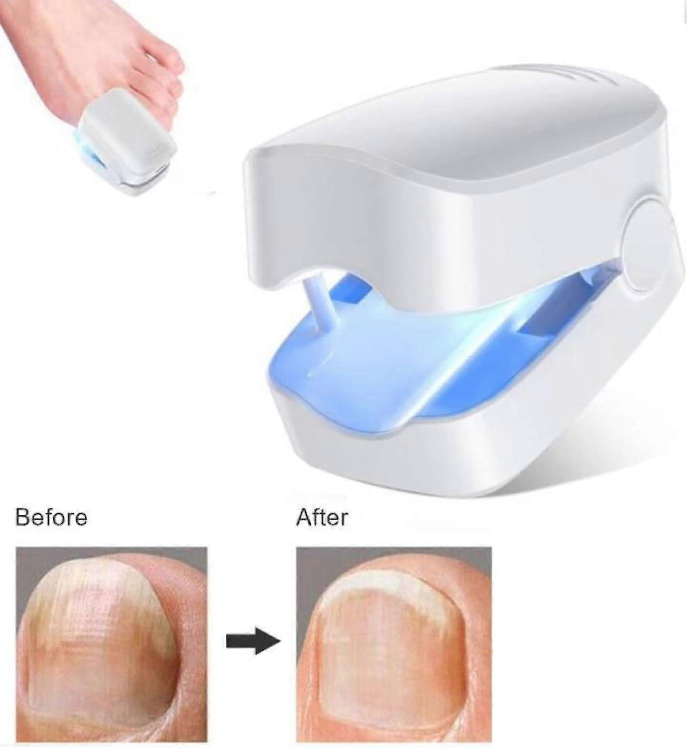 Nail Fungus Laser Treatment, Anti Fungal Laser-device, Finger Toe Nail ...