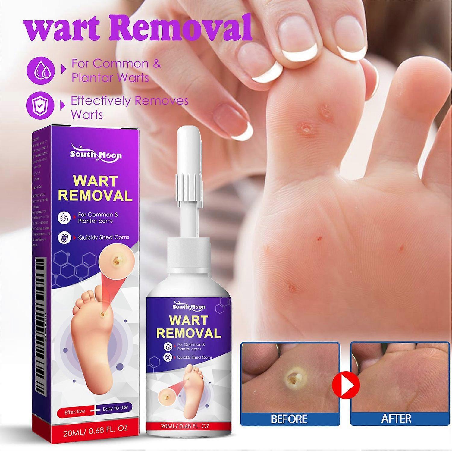 1-3pcs Wart Remover Drops 20ml Wart Remover Treatment Liquid Drops for ...