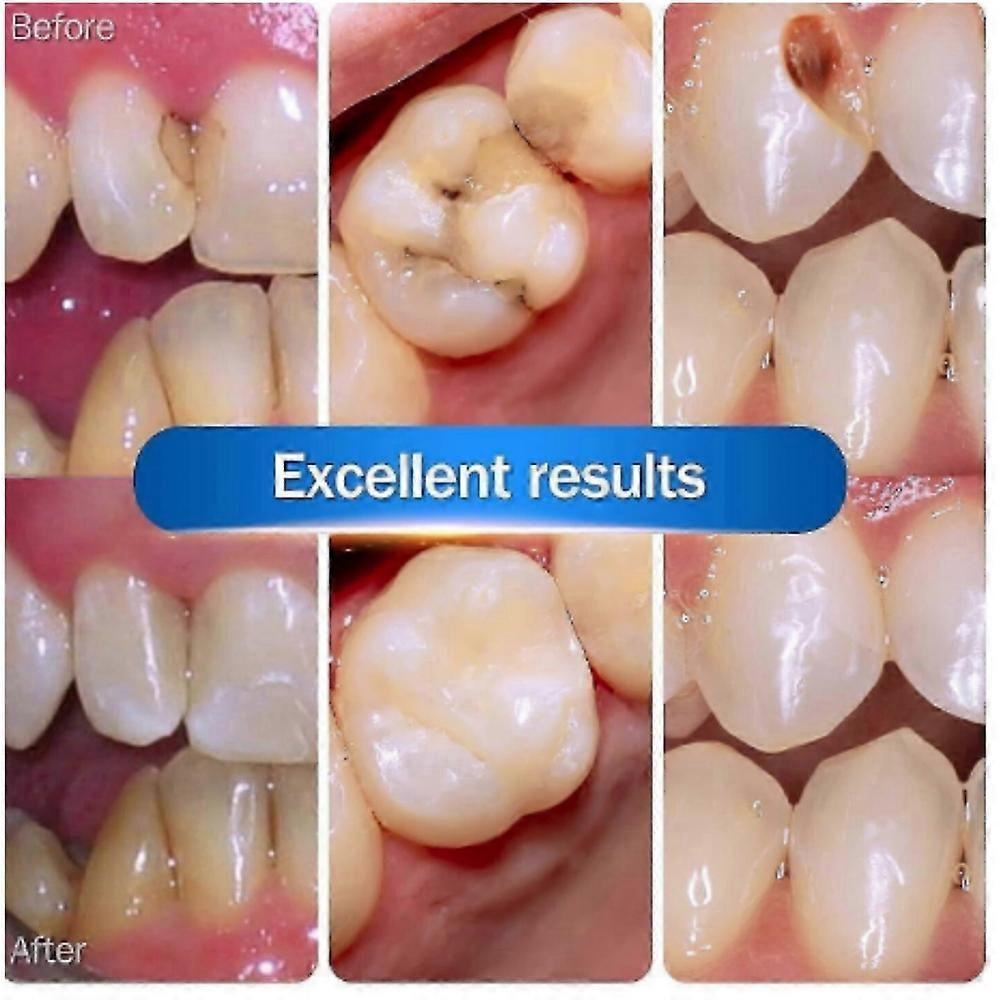 Teeth Resin Tooth Repair Dental Cement Cavity Filling Strong Repair ...
