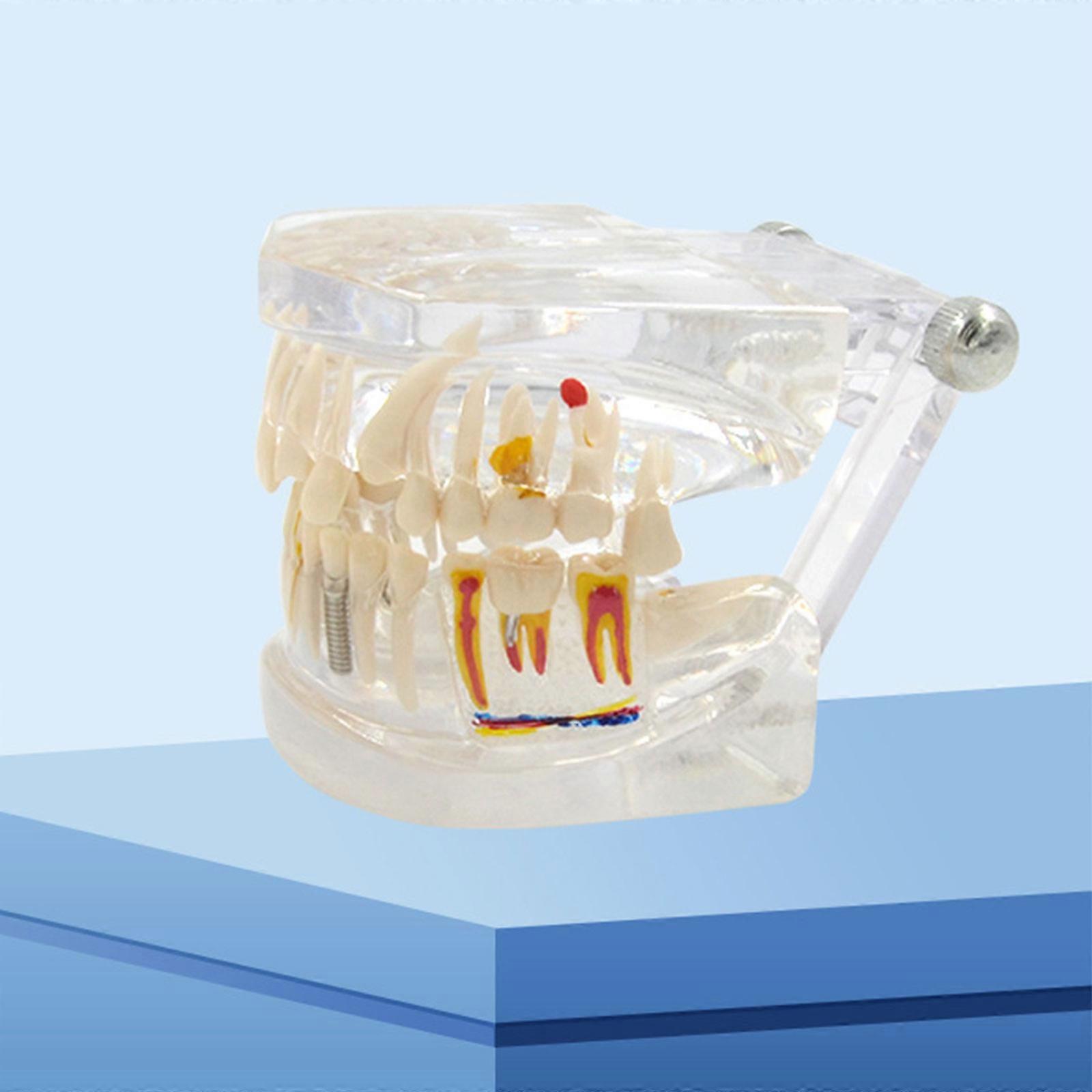Transparent Dental Implant Model Removable Teeth Portable Disease Teeth ...
