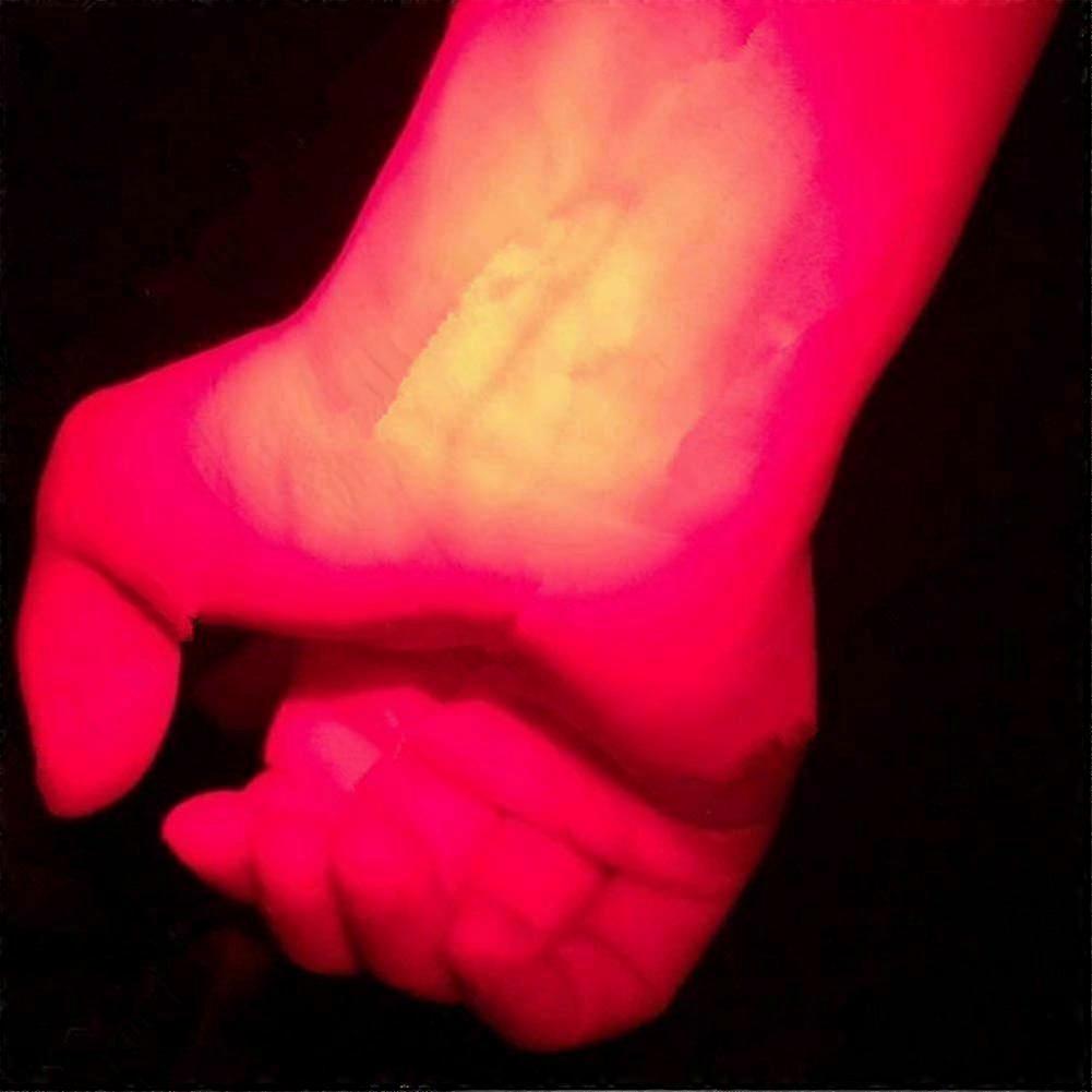 Infrared Vein Imaging Red Light Torch Pediatric Unit Clinicians Nurses ...