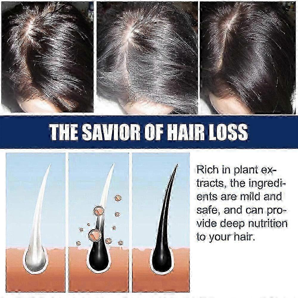 1-3x nya alopeci behandling kräm hår växer förhindra alopeci skallighet ...