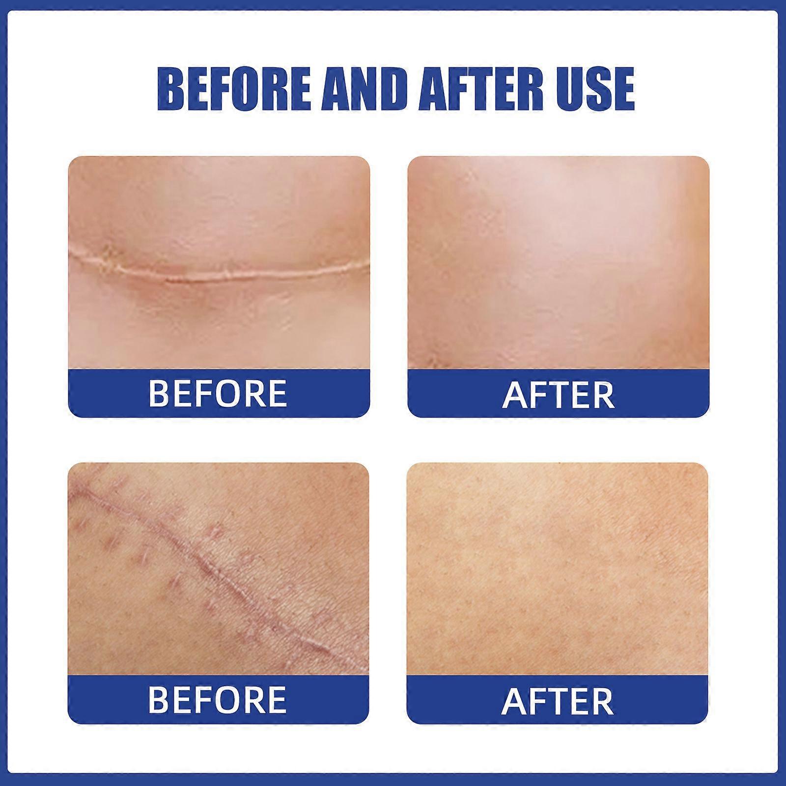 Silicone Scar Sheets Silicone Scar Sheets For Breast 4 Pairs Breast ...