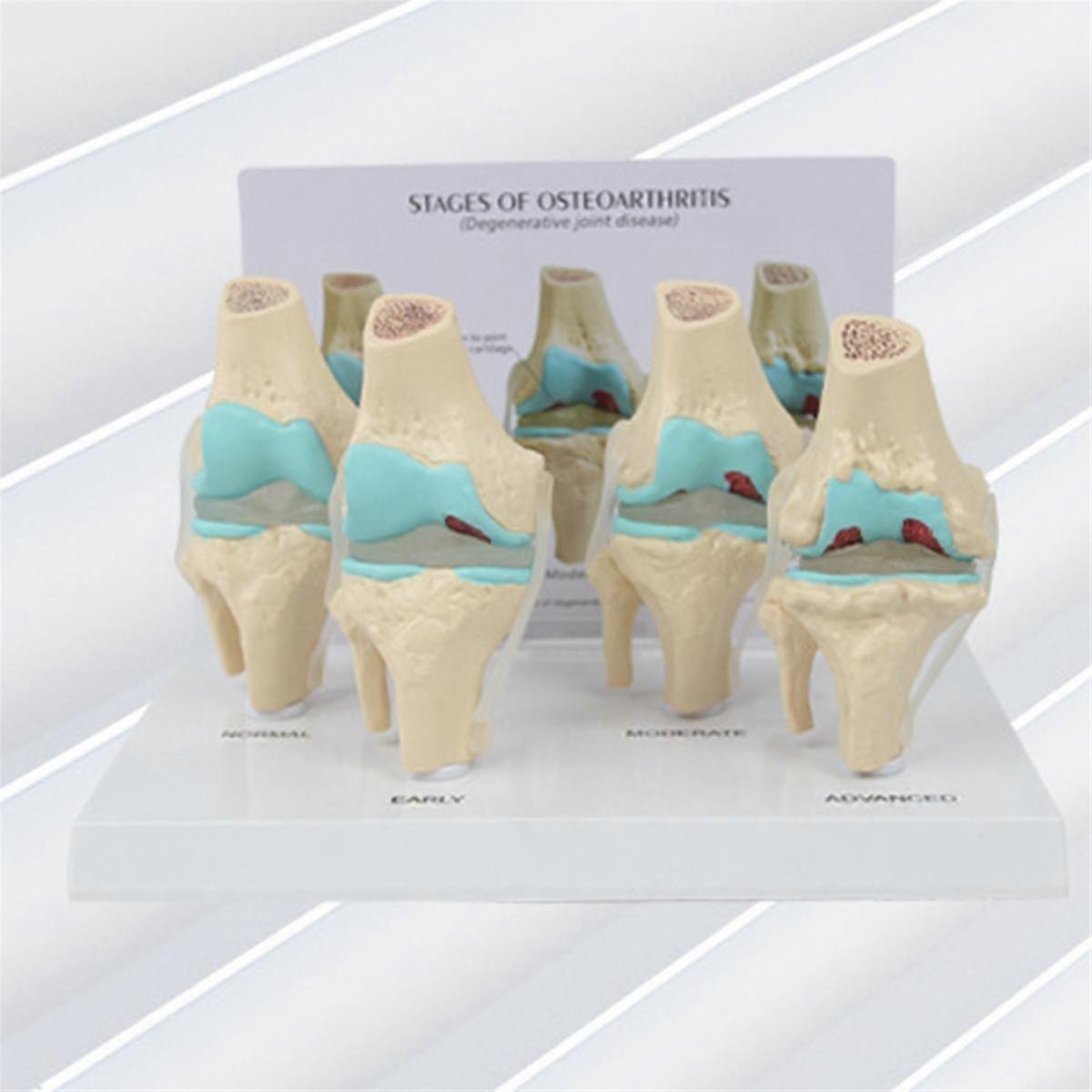 Knee Kit Osteoarthritis Anatomy Model with Educational Key Card 4 Stage ...