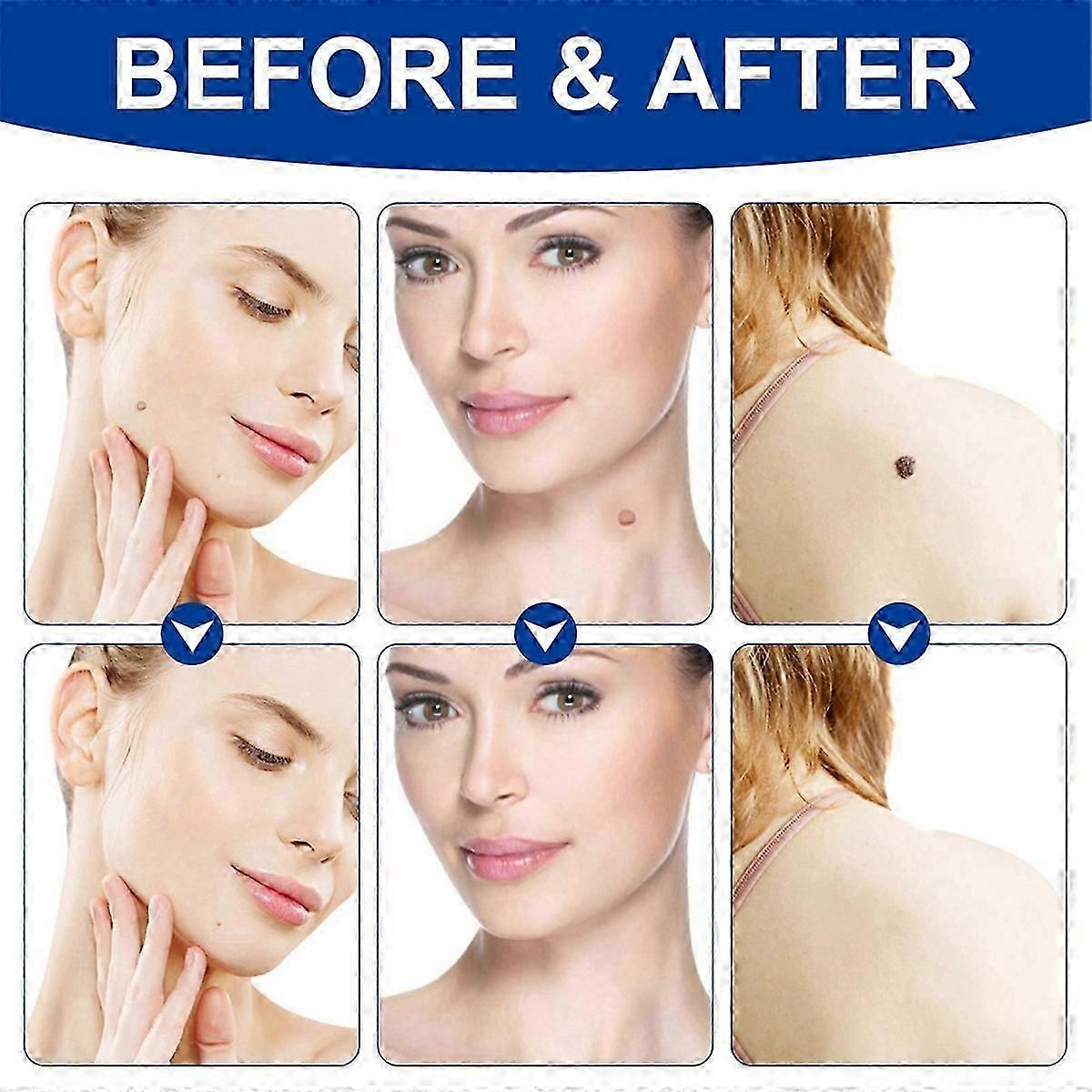 Skin Tag Removal Kit Painless Skin Tag Removal Pen Easy Skin Tag ...