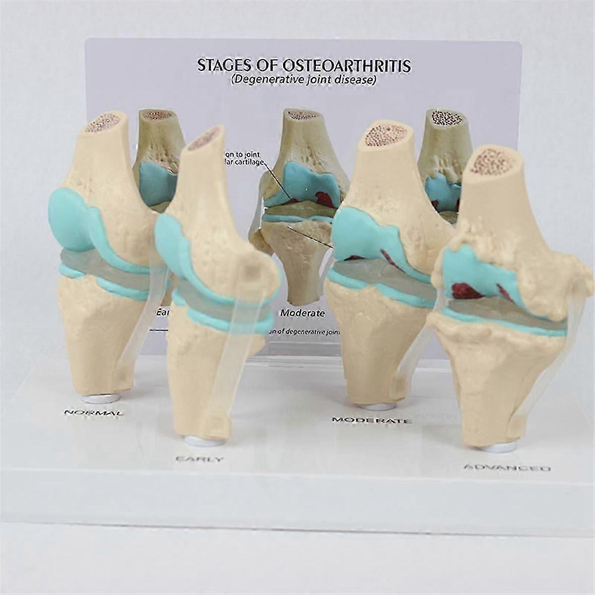 Knee Kit Osteoarthritis Anatomy Model with Educational Key Card 4 Stage ...