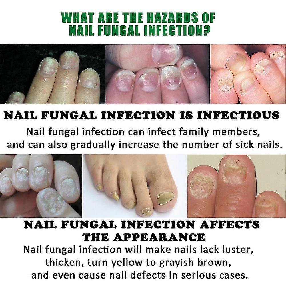 Nagelschimmel Behandelingen Serum Voetverzorging Serum Teen Nagels ...