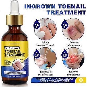 Ingrown Toenail Treatment 60ml, Softener Ingrown Toenail for Easy ...