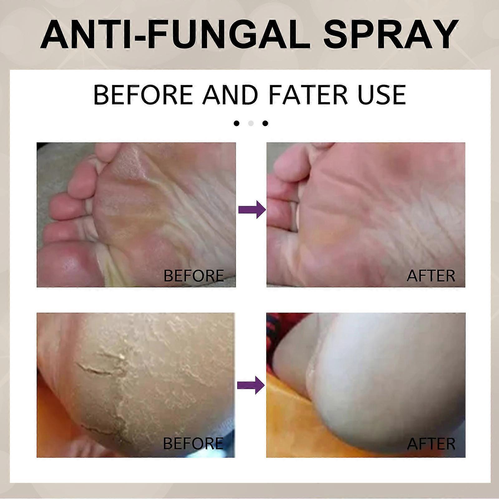 30ml Herbal Fungal Combat Feet Spray Anti Fungal Infections Prevent ...