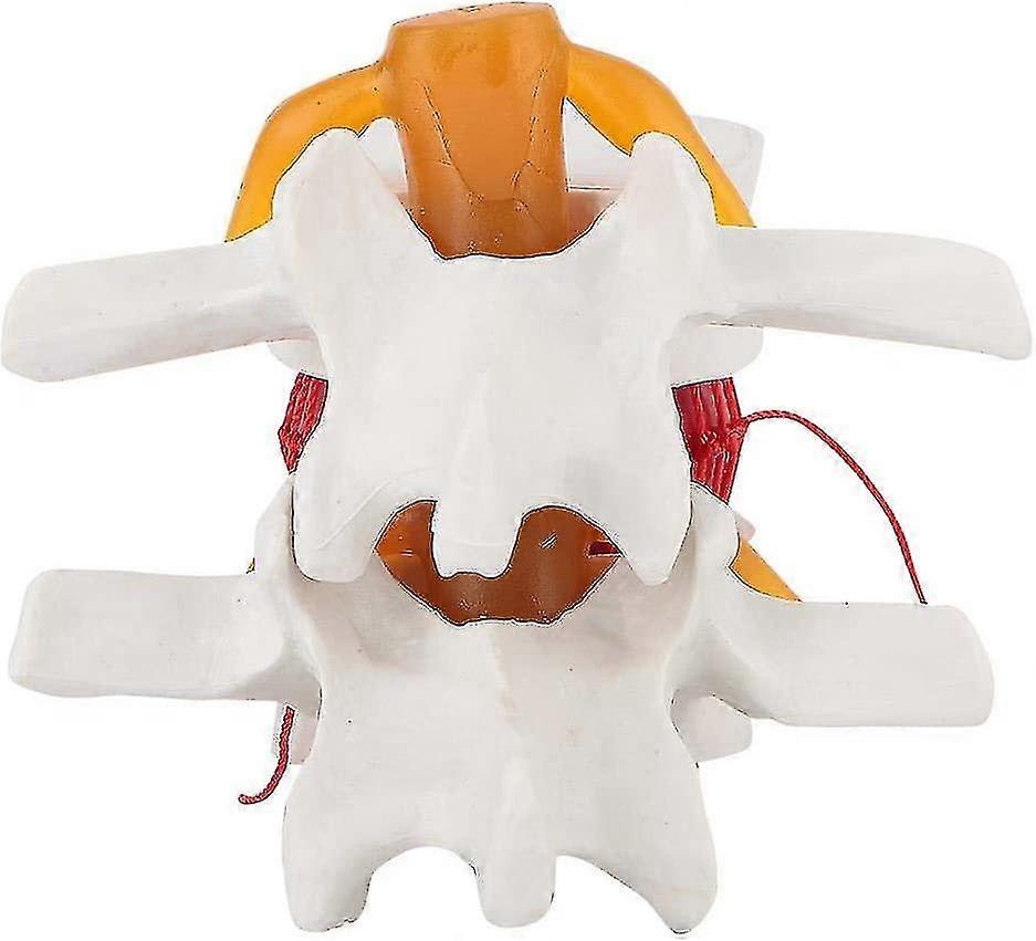 Human Anatomy, 1:1.5 Human Lumbar Disc Herniation Demonstration Model ...