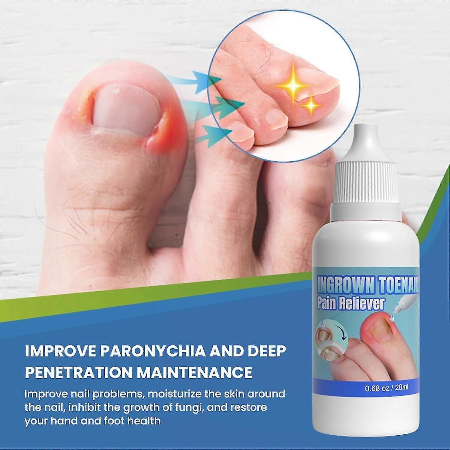 Ingrown Toenail Treatment Extra Strong, 20ml Ingrown Toenail Drop ...