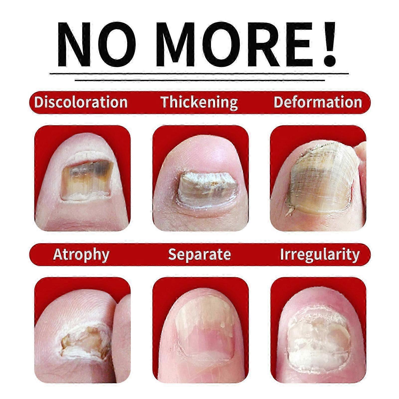 7days Nail Treatment, Ginger Nail Treatment, Multi-purpose Nail Repair ...