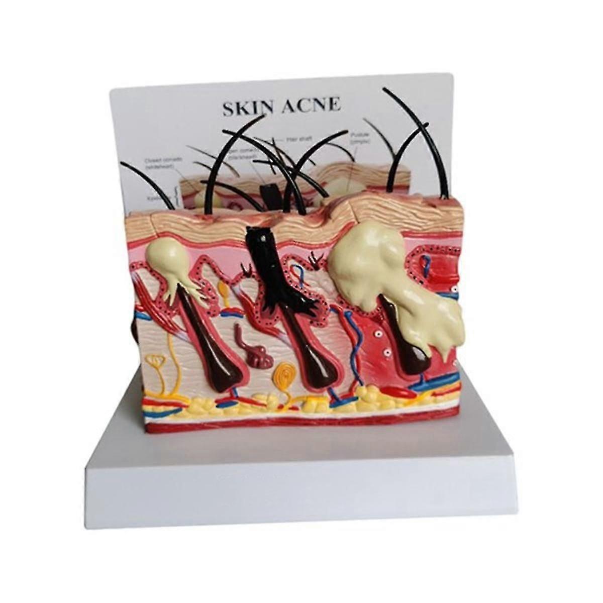 Skin Acne Model, Human Anatomy Normal Common Acne Skin, Physiology ...