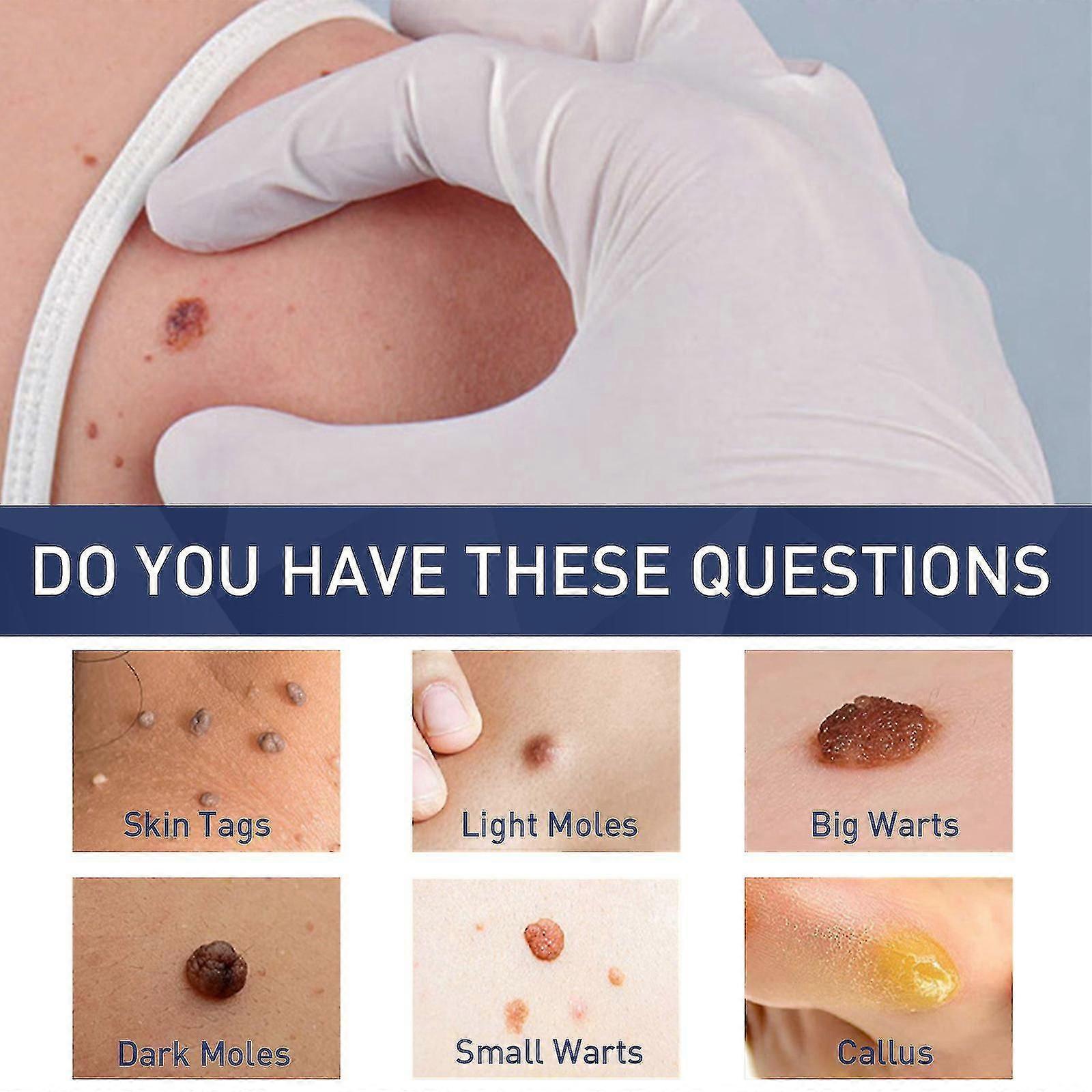 Jaysuing Gram Wart Agent Skin Especially Chicken Eye Meat Thorn Body ...