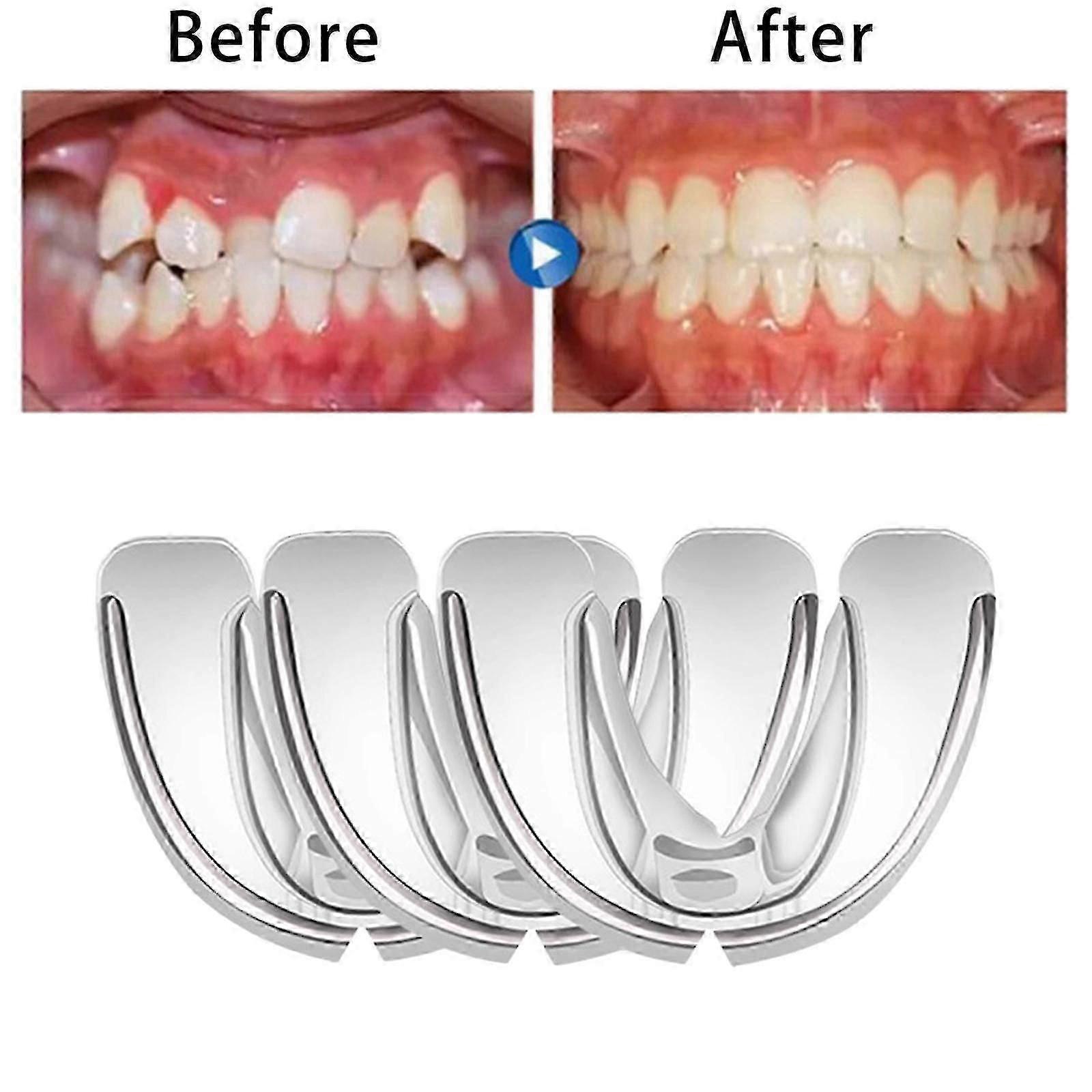 Teeth Retainer Tooth Aligners - 3-in-1 Trays for Straightening and ...