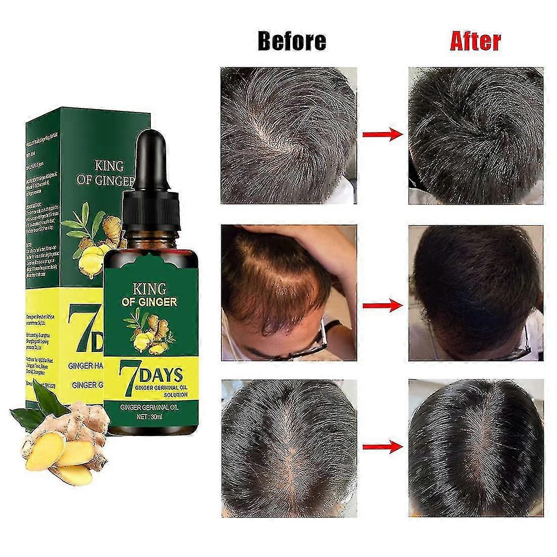 1pc Hair growth serum, Ginger Hair Growth Germinal Oil, Regrow 7 Days ...