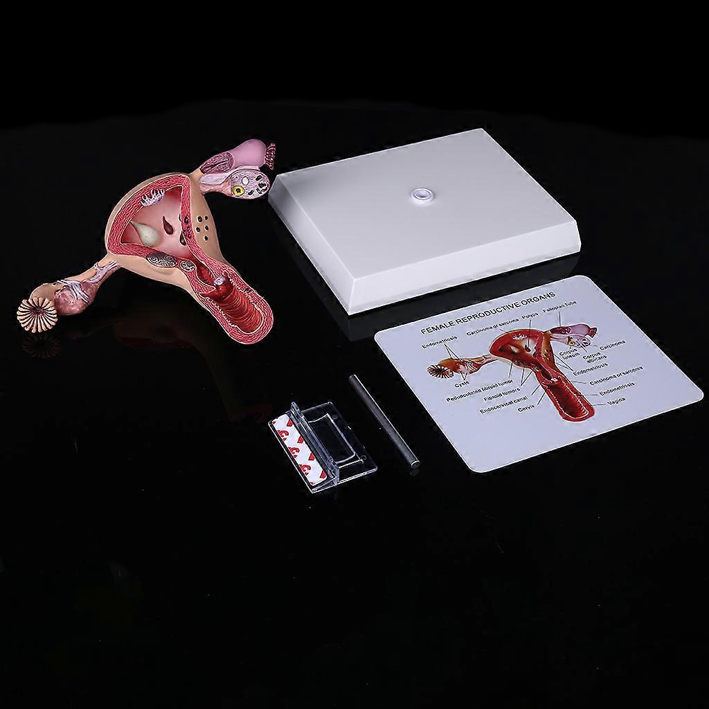Human Female Uterus Ovary Disease Dissection Pathology Model Biology ...