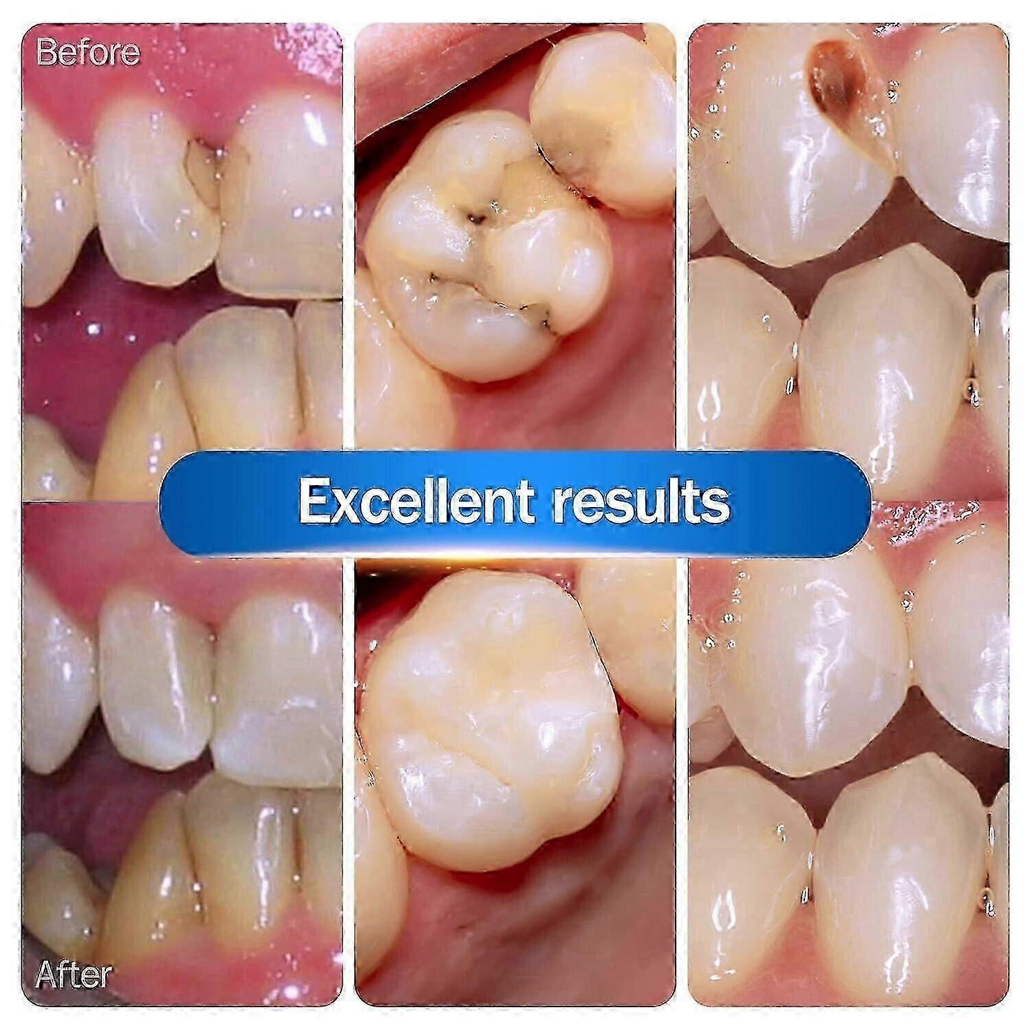 Teeth Resin Tooth Repair Dental Cement Cavity Filling Strong Repair ...