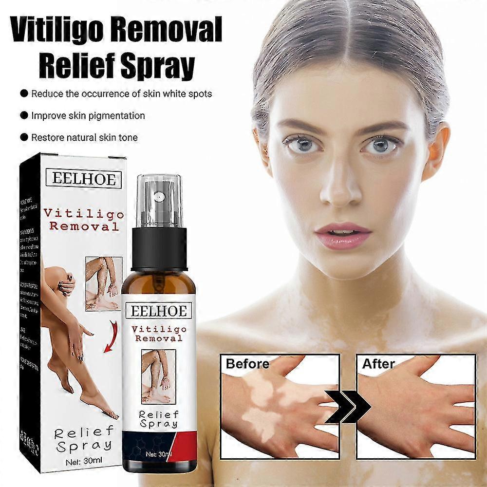 Vitiligo Spray, Vitiligo Treatment For Skin Vitiligo, Vitiligo Care ...