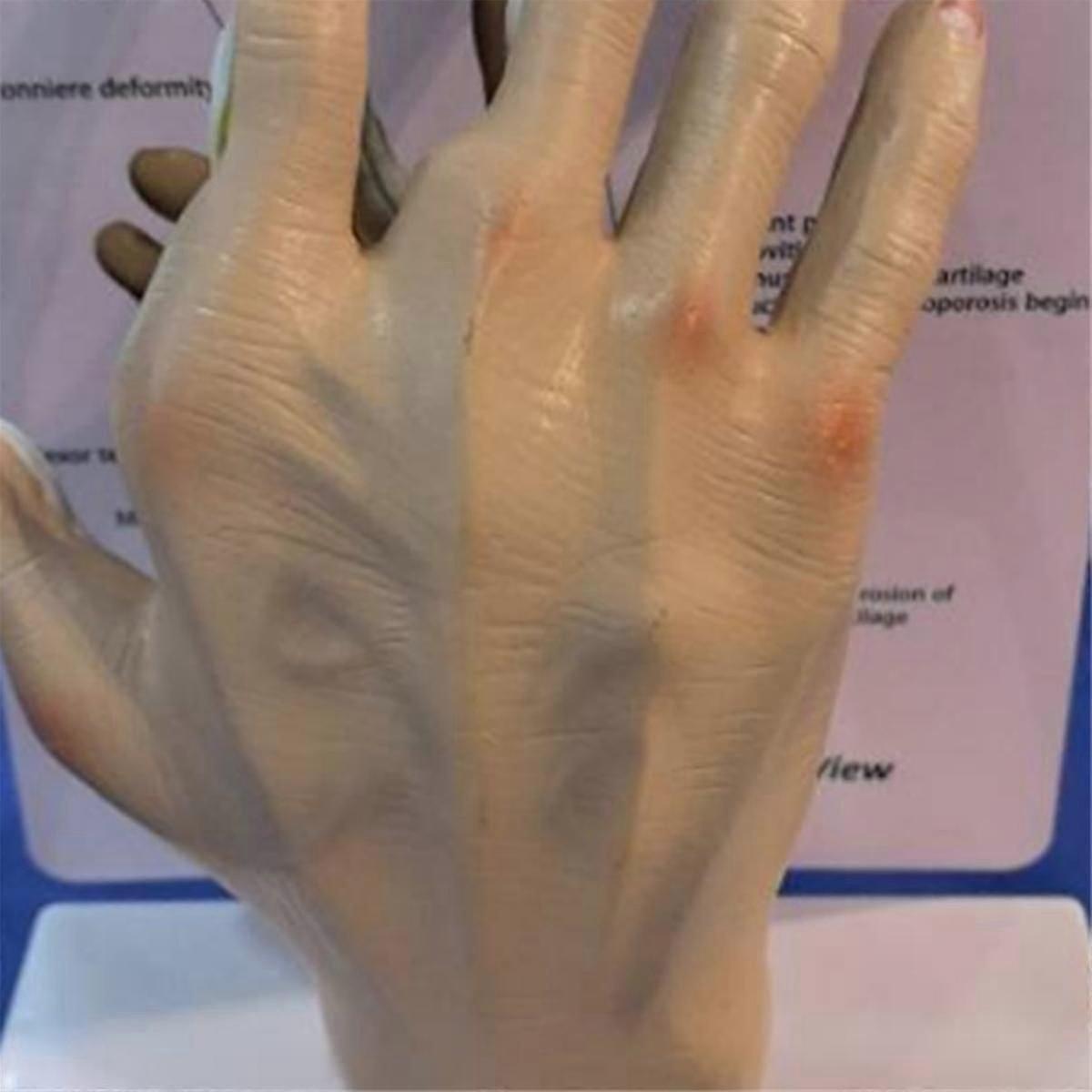 Osteoarthritis Hand Model, Model Of Hand Pathology, Human Anatomy And ...