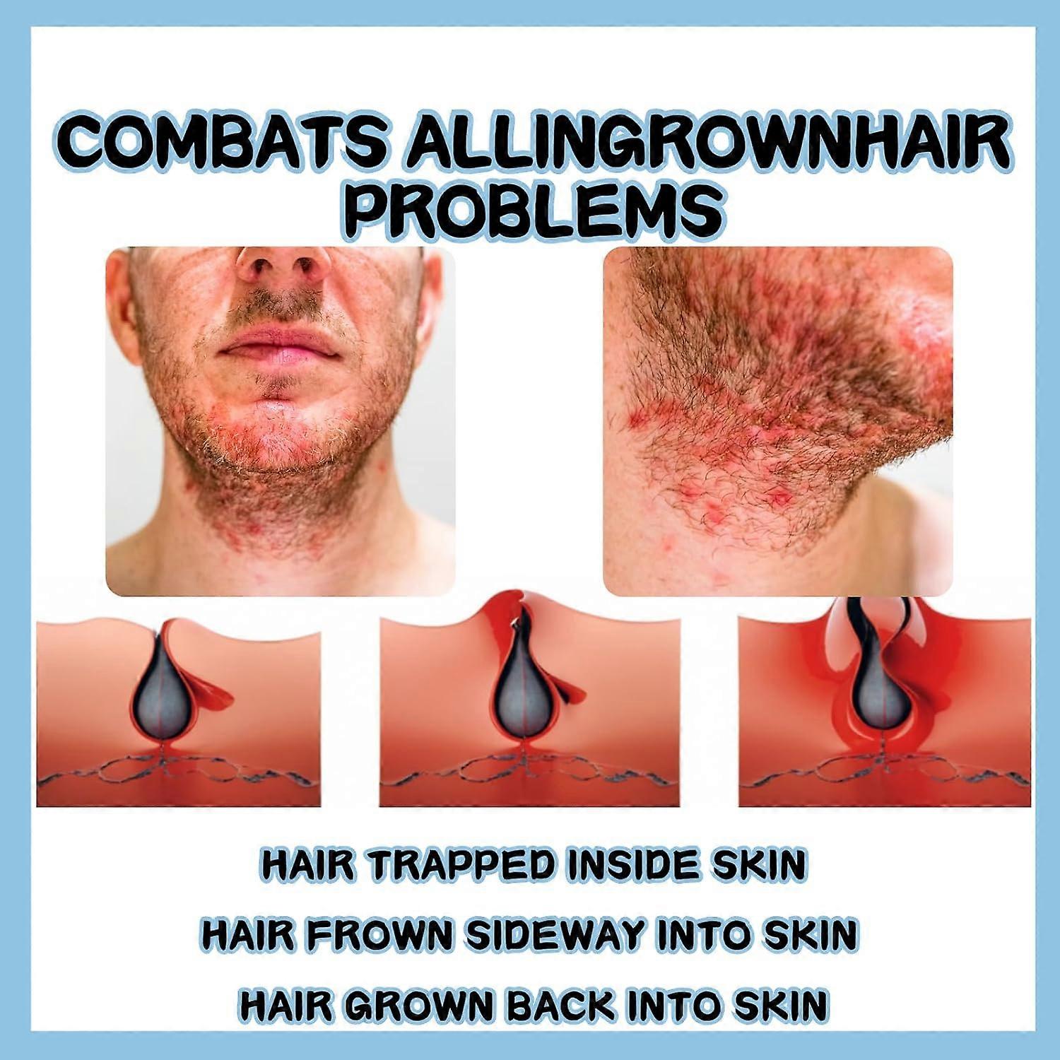 Razor Bumps Treatment For Men And Woman, Ingrown Hair Treatment After ...