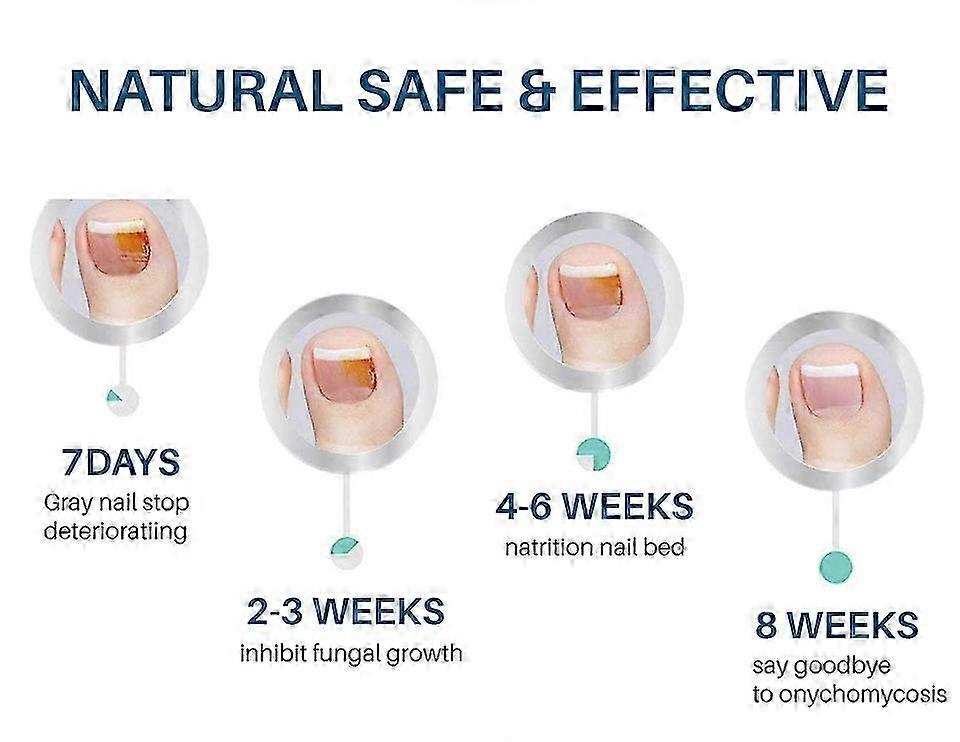 Nail Fungus Care Liquid for Nail Treatment Onychomycosis Antibacterial ...