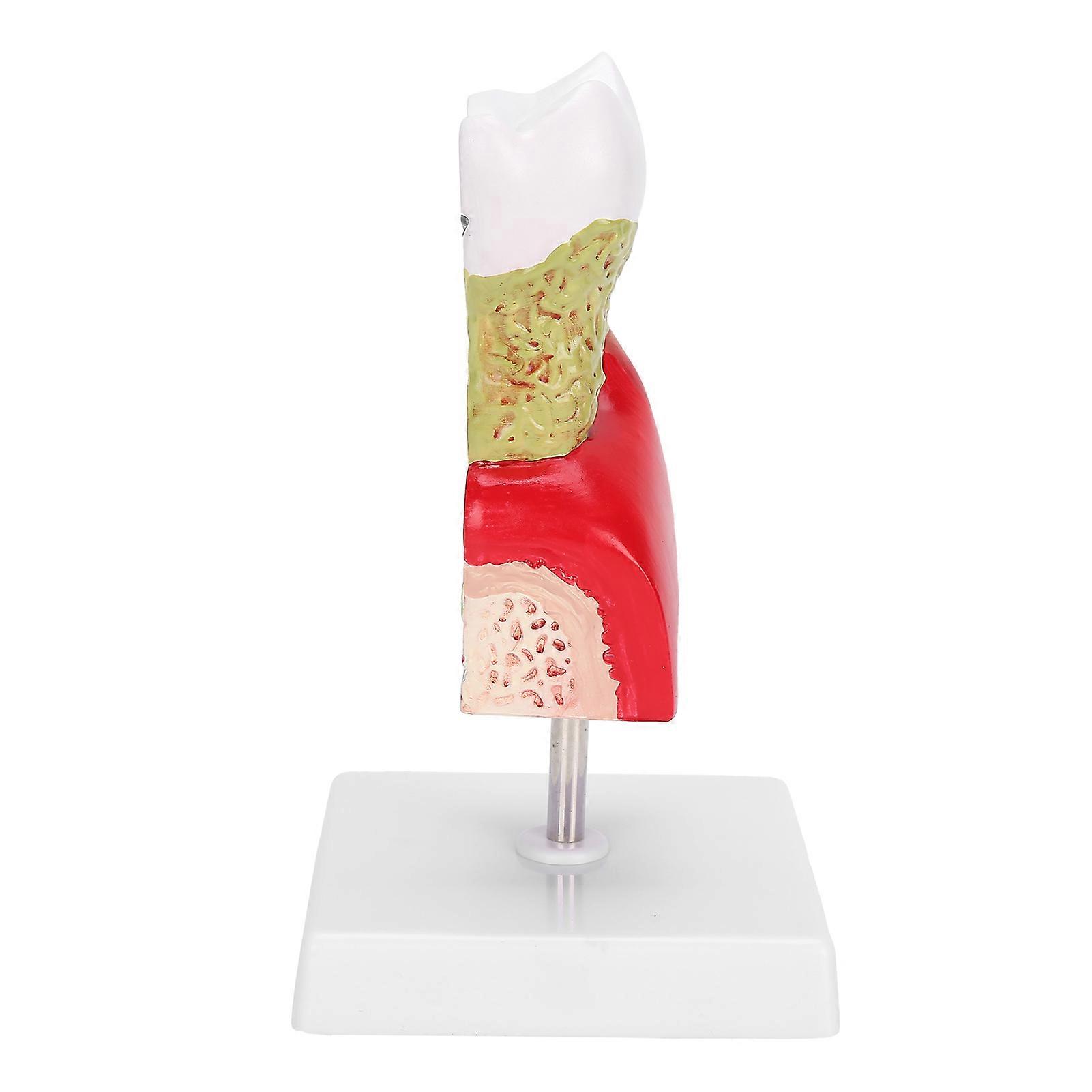 Dental Caries Tooth Model Dental Teeth Model for Teaching Training ...
