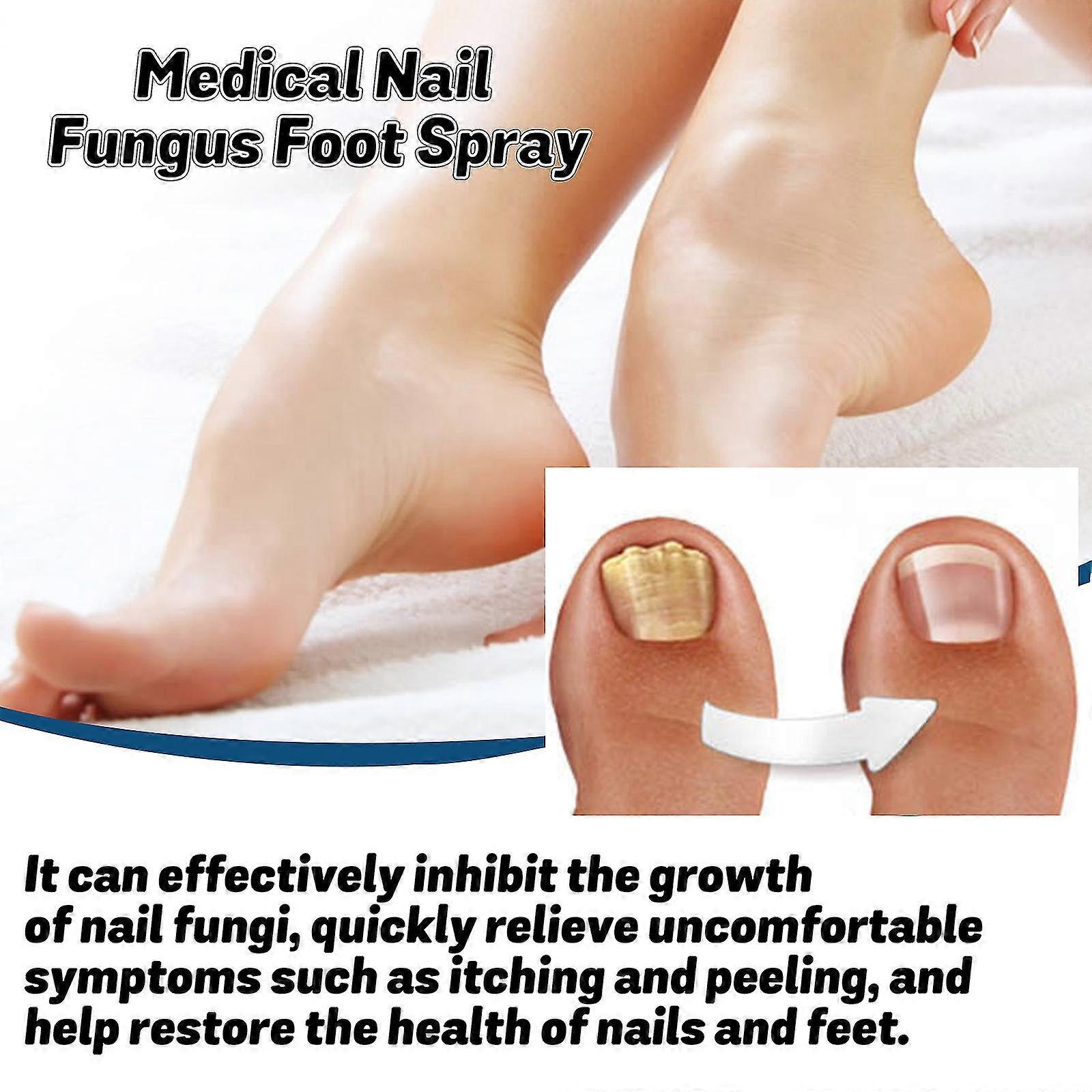 Medical Nail Fungus Foot Spray, Herbal Care Medical Grade Nail Foot ...