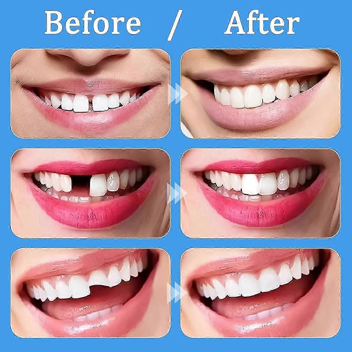 Tooth Filling Repair Kit, Temporary Teeth Filler With 4 Dental Tools ...