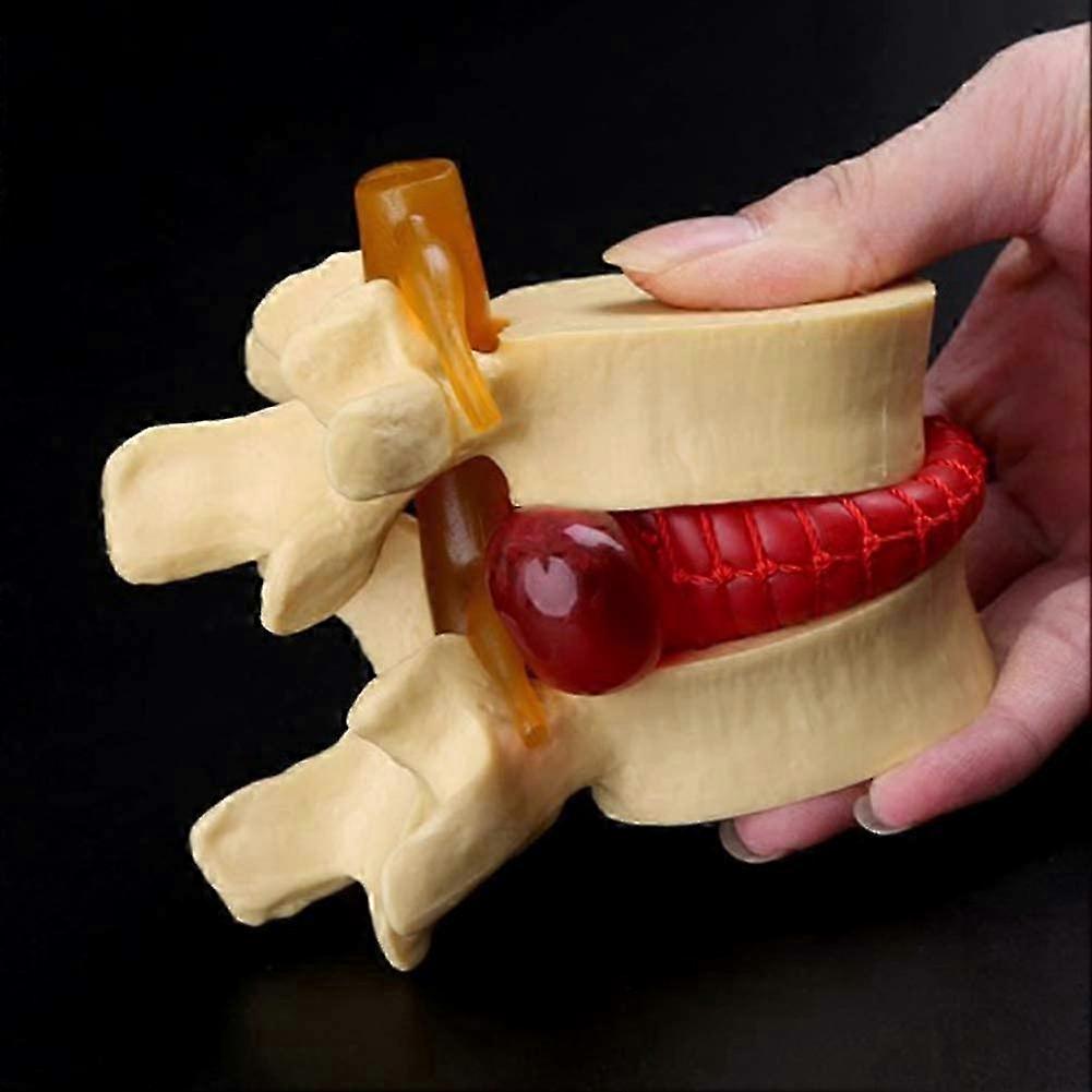 Lumbar Vertebrae Model Anatomical Spine Lumbar Disc Herniation Anatomy ...