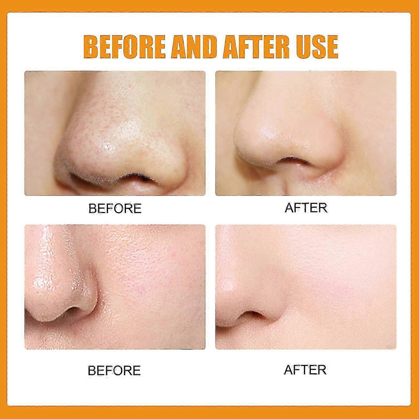 Eelhoe Removes Blackheads And Pimples Nasal Paste Cleans And Shrinks ...