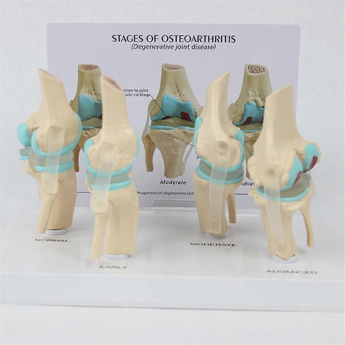 Knee Kit Osteoarthritis Anatomy Model with Educational Key Card 4 Stage ...