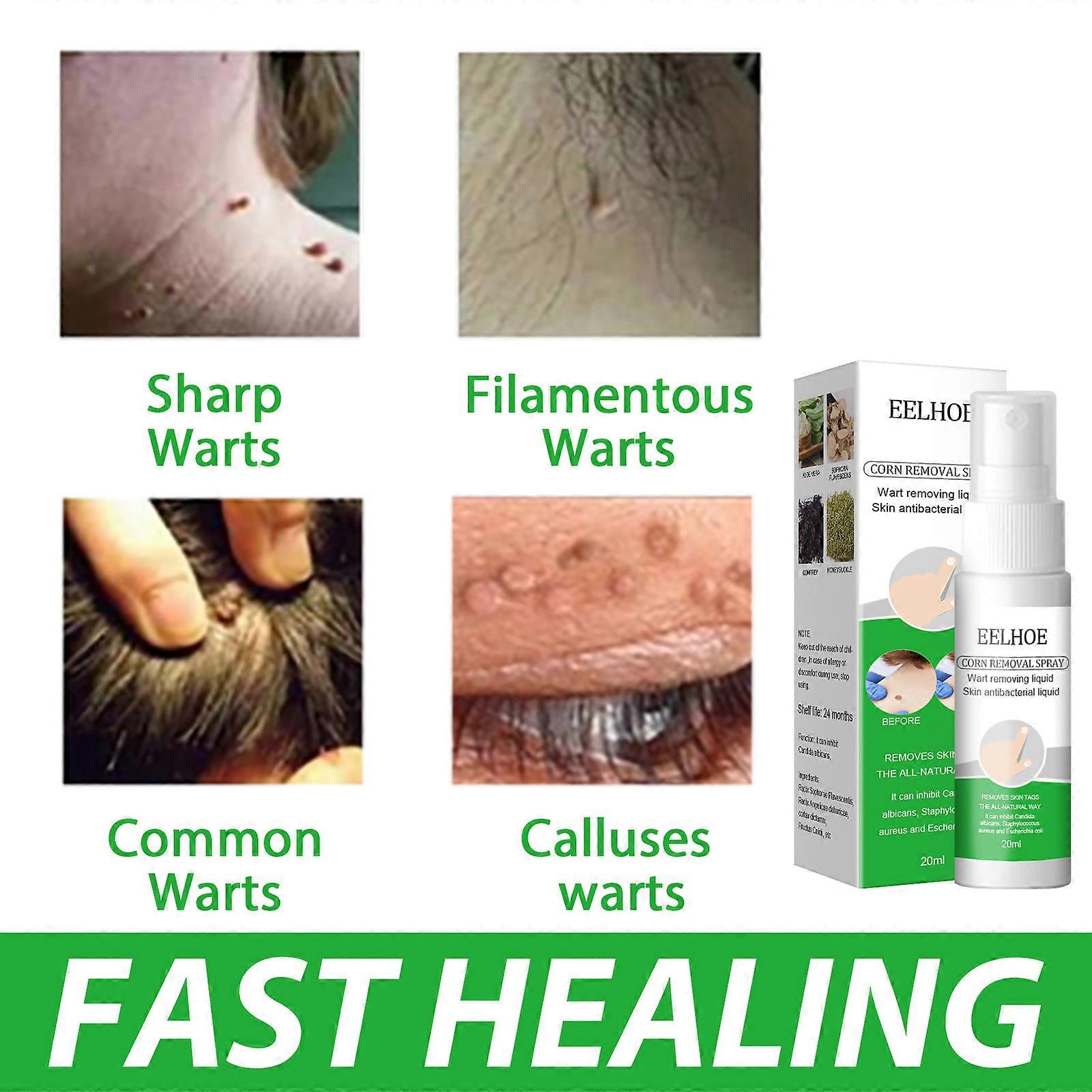 Wart-removing liquid to remove thorns, flat hands, foot calluses, corns ...