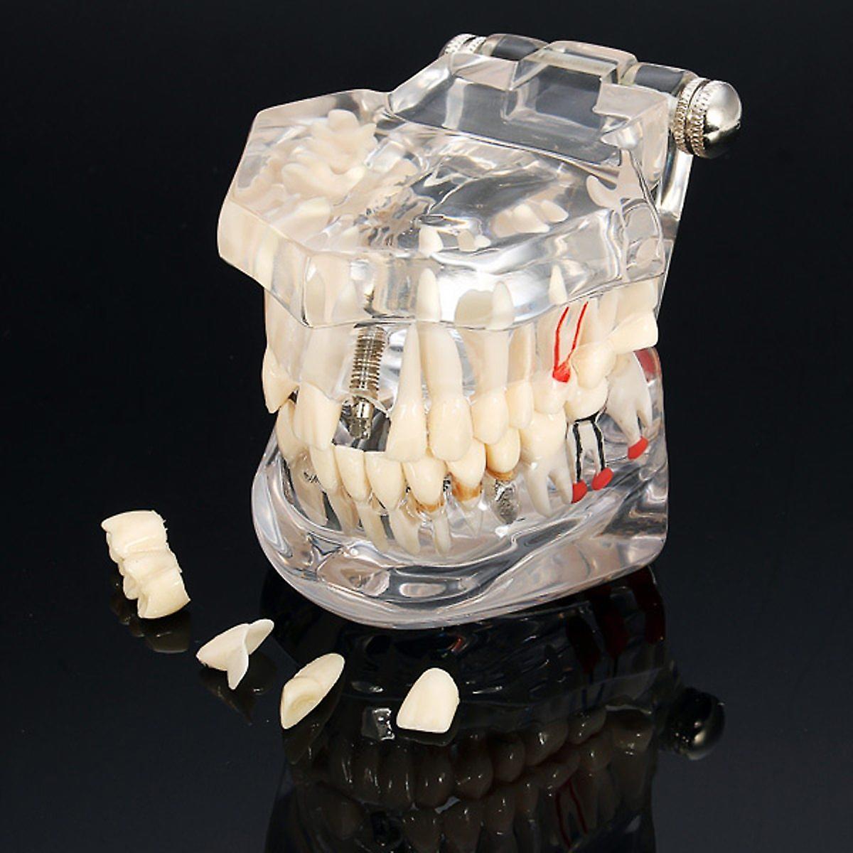 Implant Dental Disease Teeth Model With Restoration Bridge, Tooth ...