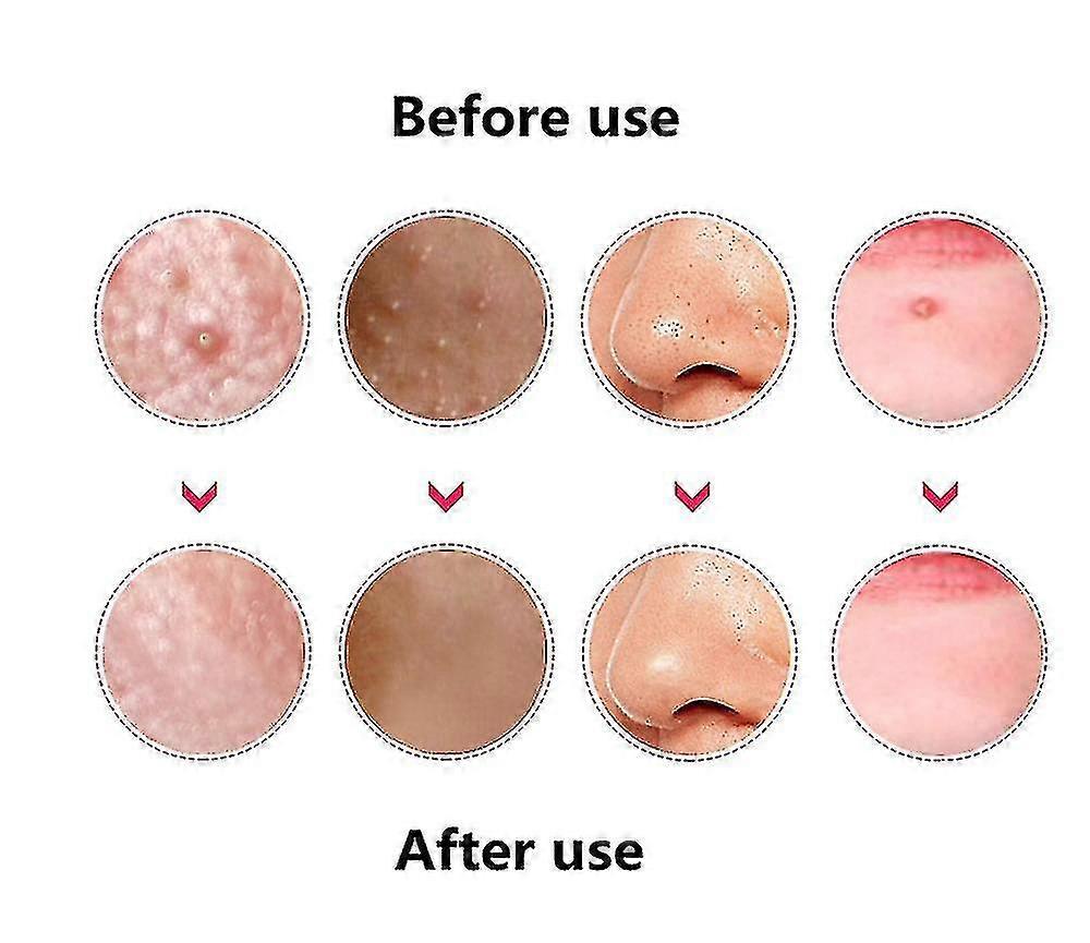 Professional Surgical Blackhead Remover Tools, Blemish And Splinter ...