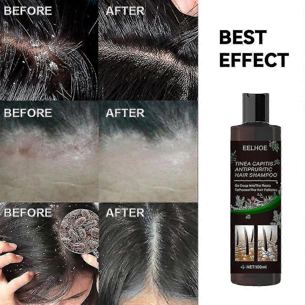 100ml Scalp Ringworm Anti-itch Shampoo Dandruff Control Oil Anti-itch ...