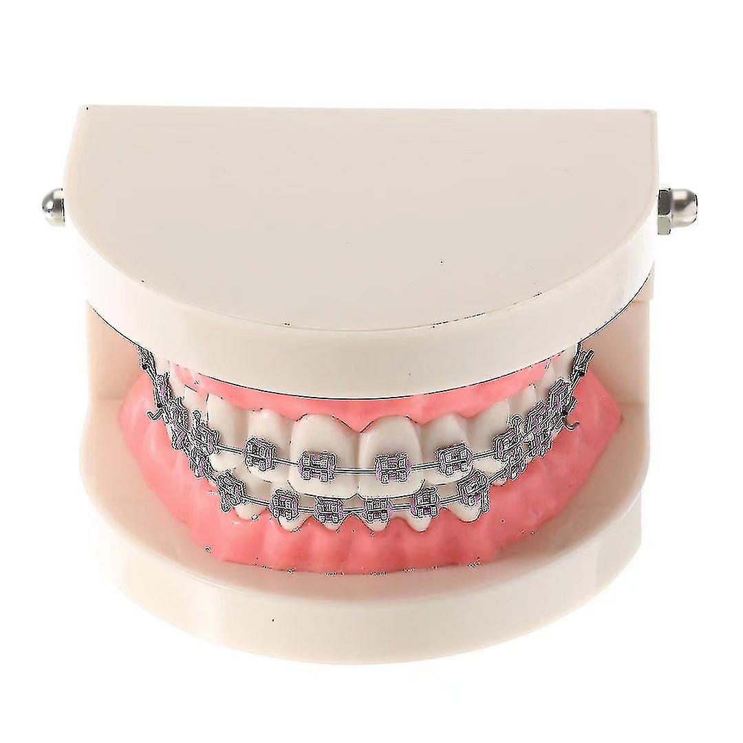 Ortodoncia dental Modelo de dientes con orto metal Cerámico Bracket ...