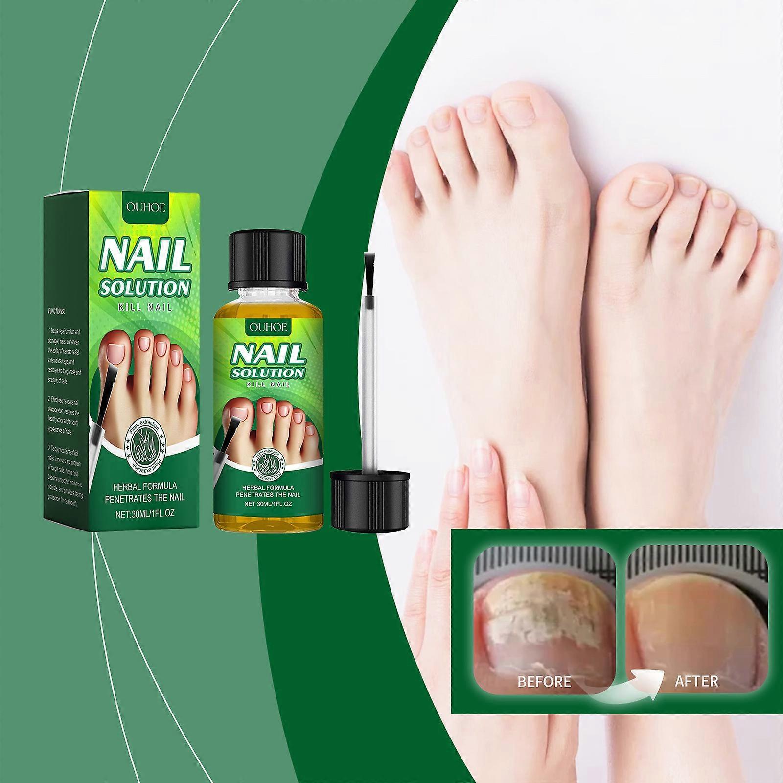 Nail Solution, Nail Repair Solution, Onychomycosis Nail Care Nail ...