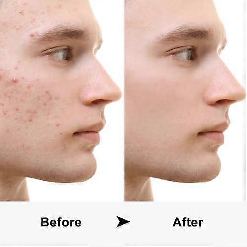 LED Acne Foe - Acne Spot Pimple Zit Treatment Device Red and Blue Light ...