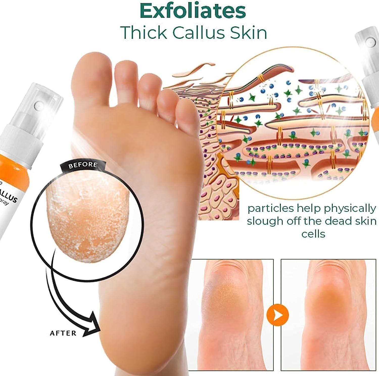 Foot Callus Removal Spray, Foot Heel Callus Remover Spray, Foot Peel ...