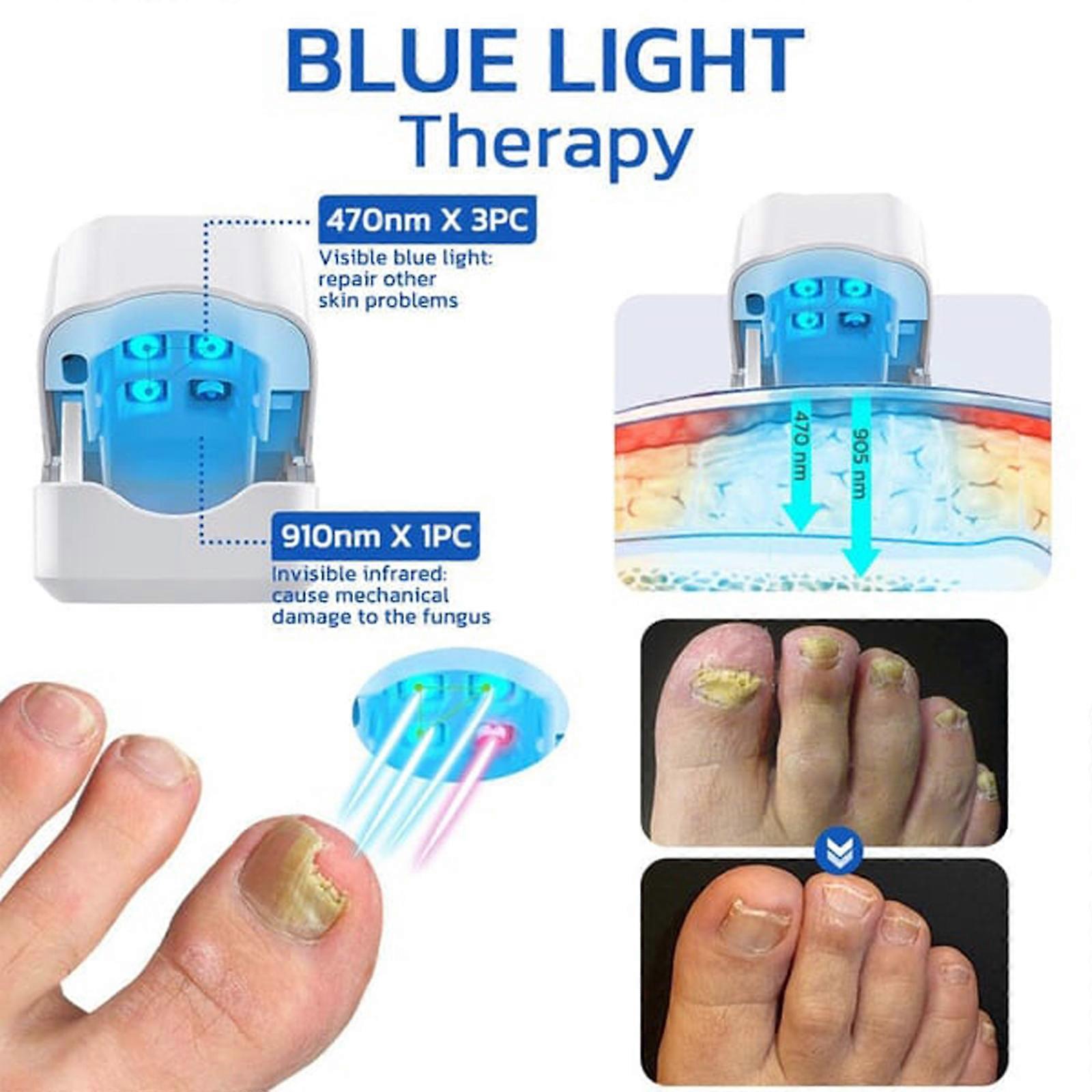 Nail Fungus Laser Device, Anti Fungal Treatment Laser Devices for ...